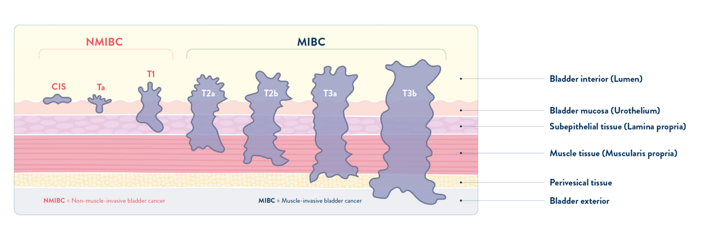 NMIBC | Bladdercare